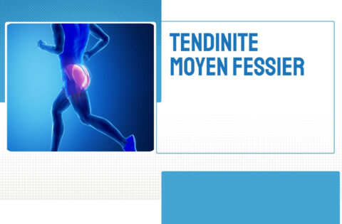 Prise en charge et traitement de la tendinite du moyen fessier